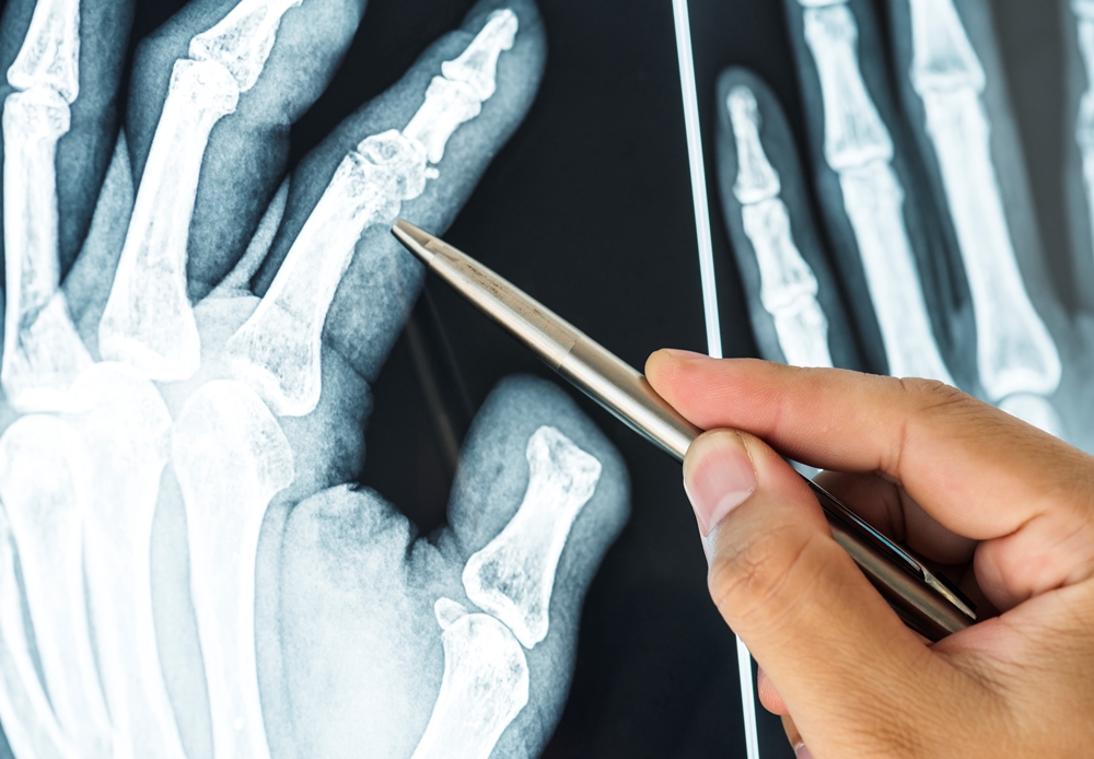 Finger fracture healing time | Ladan Hajipour Wrist and Hand Surgeon